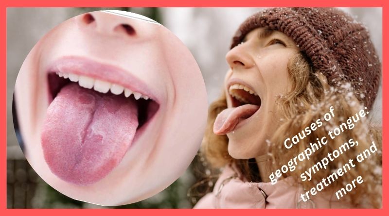 Causes of geographic tongue: symptoms, treatment and more
