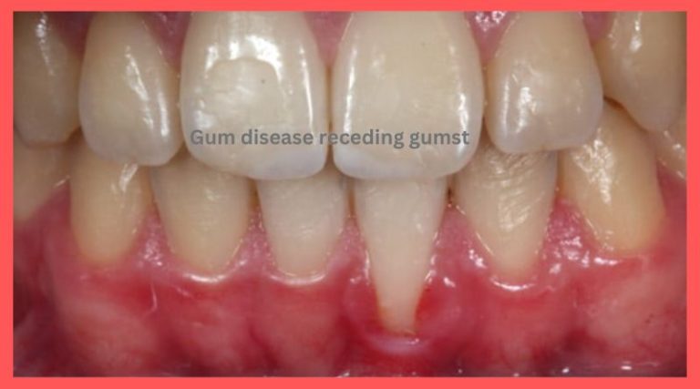Everything about the gum disease receding gums treatment