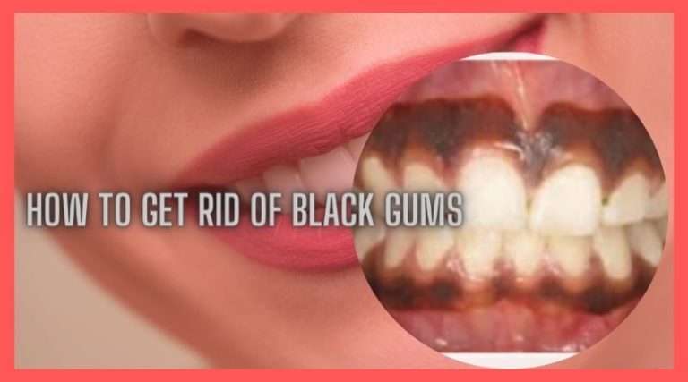 How to get rid of black gums and more